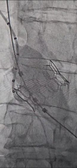 Surgical Supplies Ltd - First MyVal Octacor Case at Waikato Hospital